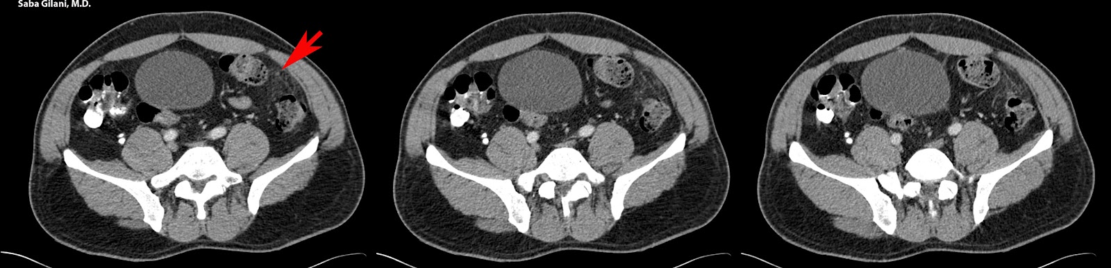 Roentgen Ray Reader: Epiploic Appendagitis