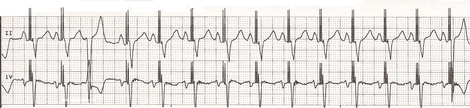 ECG Rhythm Strips 74