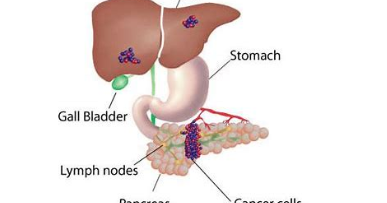 stage 3 lymphoma survival rate | Life expectancy of a Patient with ...