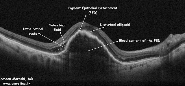 Hemorrhagic PED