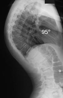 MUNDO ENFERMEDADES: DIAGNÓSTICO CIFOSIS