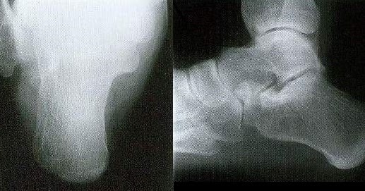 Estudo Radiográfico : ROTINA DE CALCÂNEO