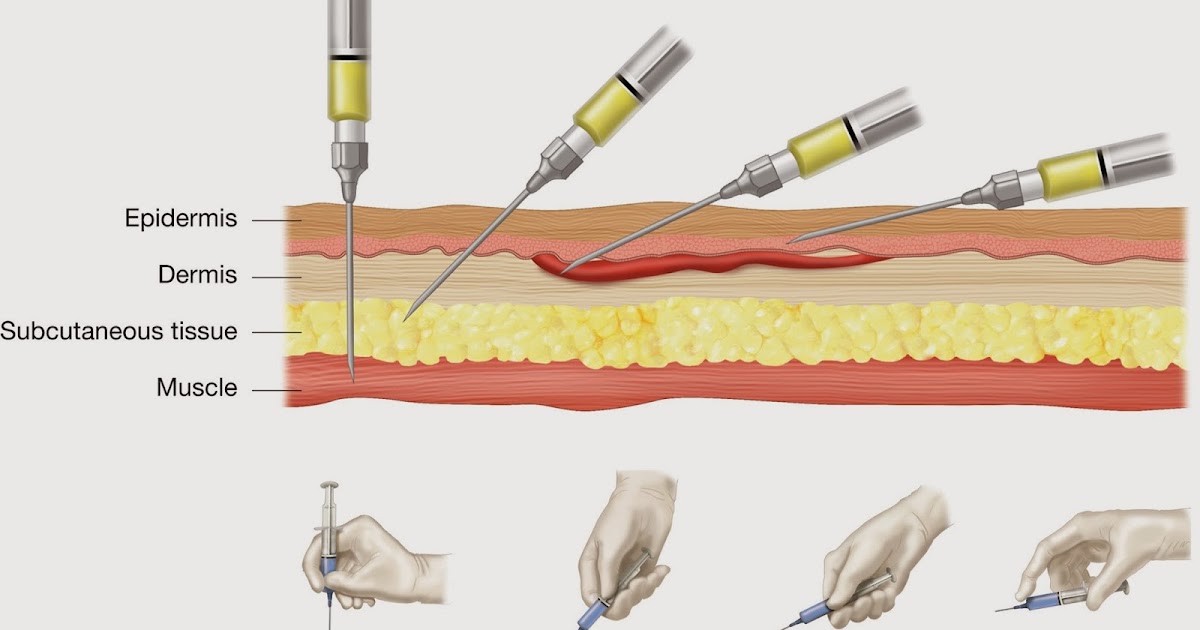 Les injections parentérales | Récap' IDE