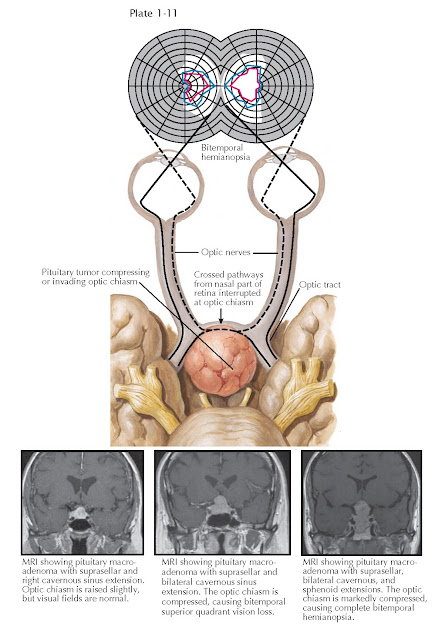 EFFECTS OF PITUITARY TUMORS ON THE VISUAL APPARATUS - pediagenosis