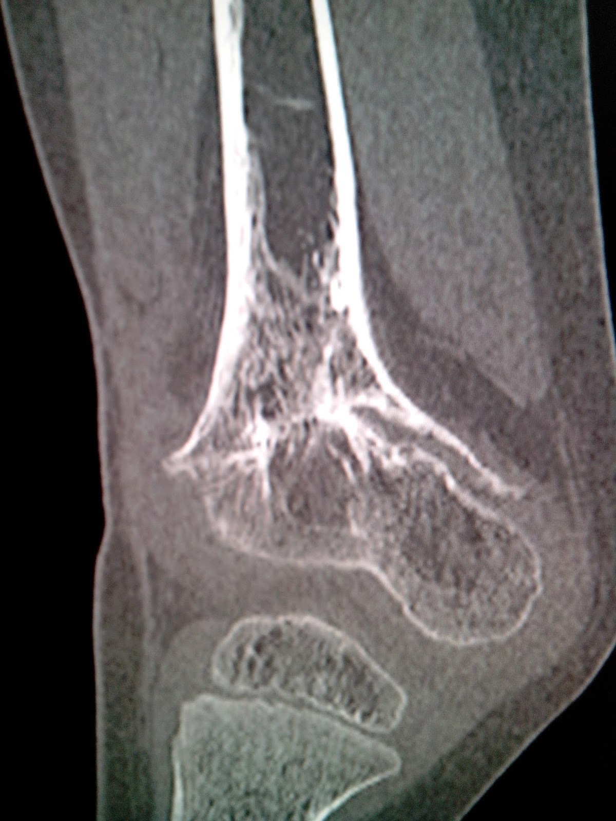 PHYSEAL BAR-CT - Radiology Imaging