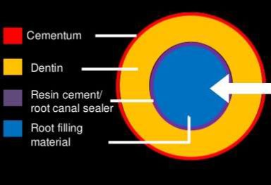 Monoblock in Endodontics [Detailed Explaination with Studies]