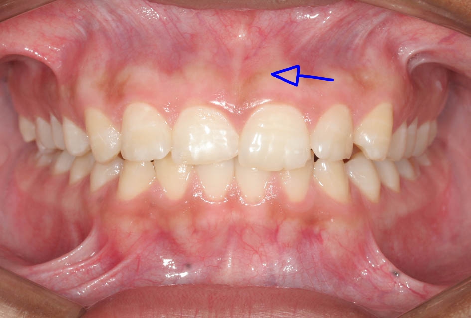 Dente Supranumerário Cirurgia Preço - RETOEDU