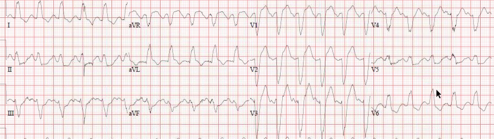 Dr. Smith's ECG Blog: LBBB. Is there Occlusion MI (OMI)? Is so, which ...