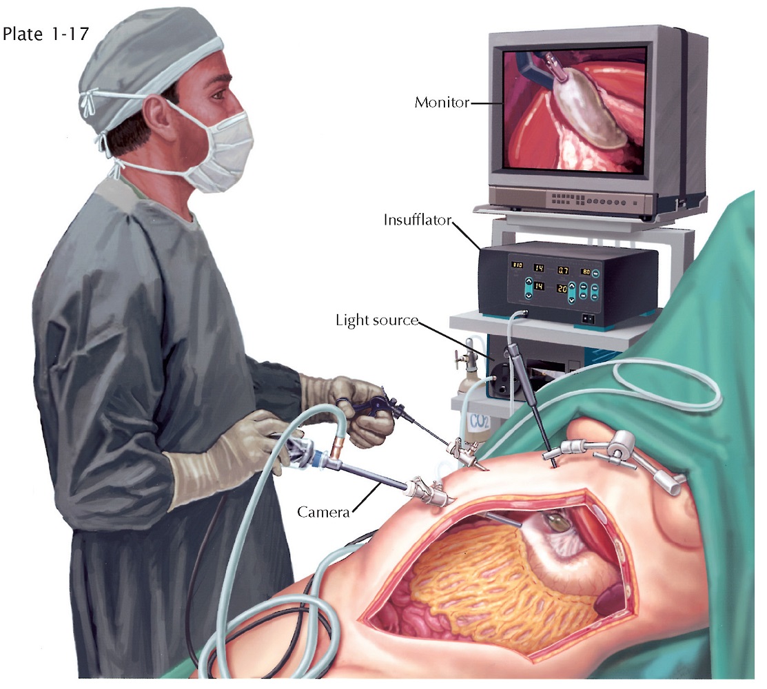 Laparoscopic Peritoneoscopy - pediagenosis