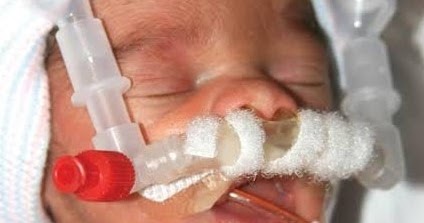 Fisioterapia intensiva: Qual a melhor interface para o CPAP em bebês?