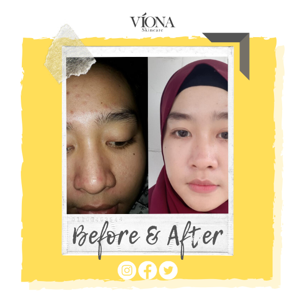 Before After Customer Viona Skincare #1 - Viona Skincare