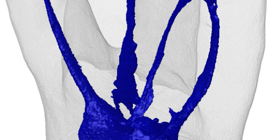 The Root Canal Anatomy Project: MB2 Canal [Maxillary First Molar]
