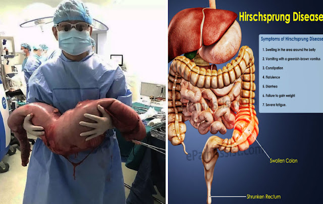 what is hirschsprung's disease Hirschsprung disease: causes, symptoms ...