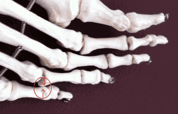 Podología Bethy: Heloma Interdigital