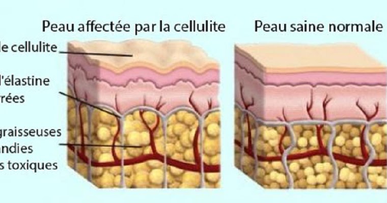 Comment se Débarrasser de la Cellulite dans les Cuisses ~ Remèdes Maison