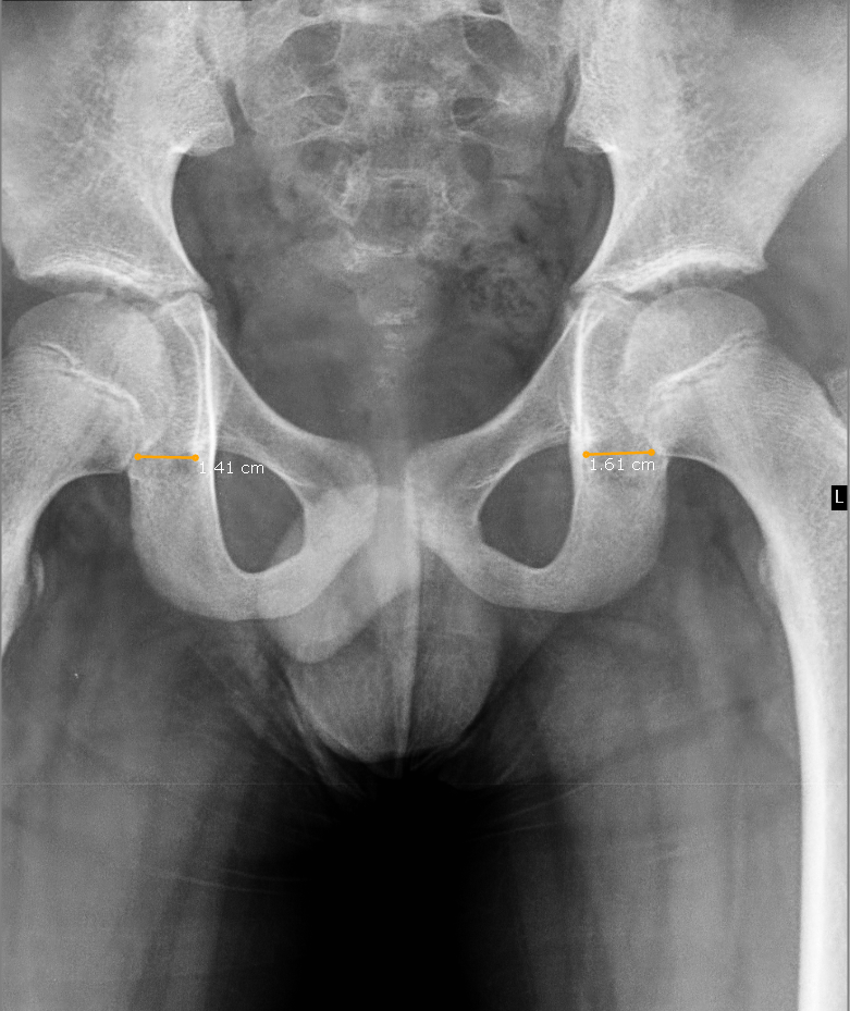 Transient Synovitis-Plain Film & MRI - Sumer's Radiology Blog