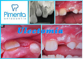 ulectomia - wood scribd braxin