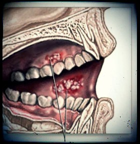 Cancer Articles (Dr. S.N White)