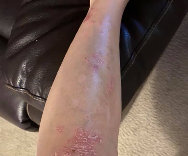 The Best Treatment For Psoriasis