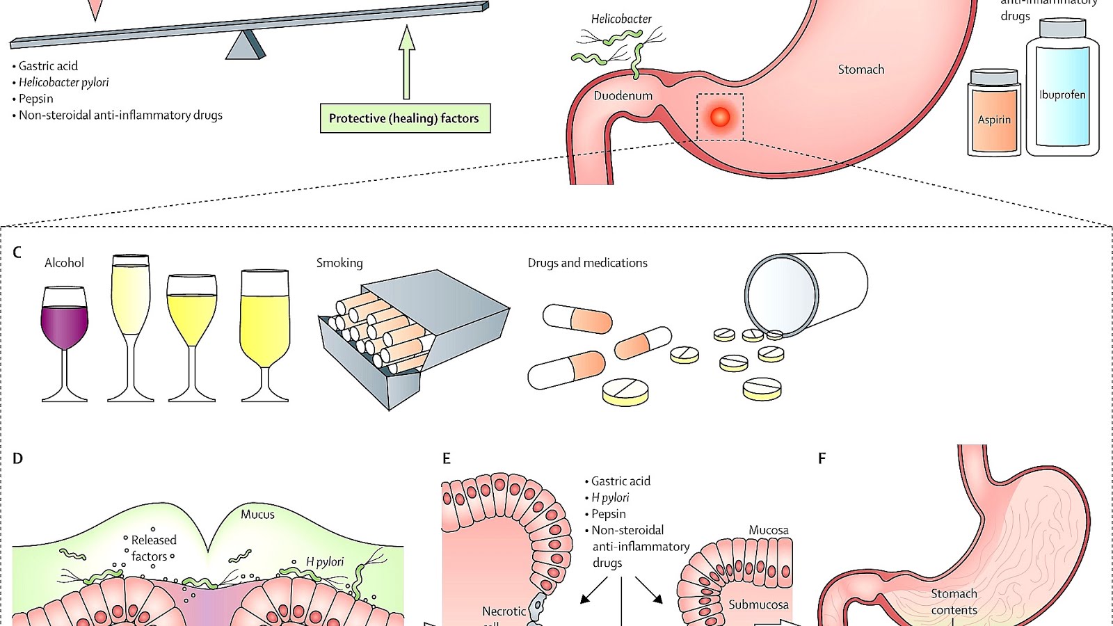 Stomach Ulcer Pain Location - Ulcer Choices