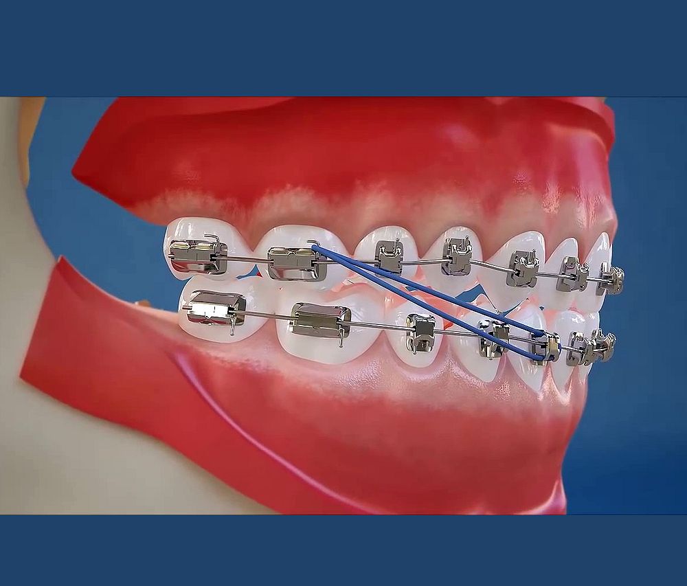¿Qué son las ligas intermaxilares? ¿Cuál es su función? - OdontoVida