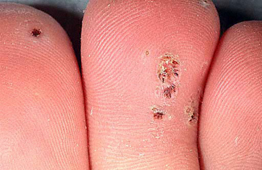 French Vocabulary Illustrated: verrue