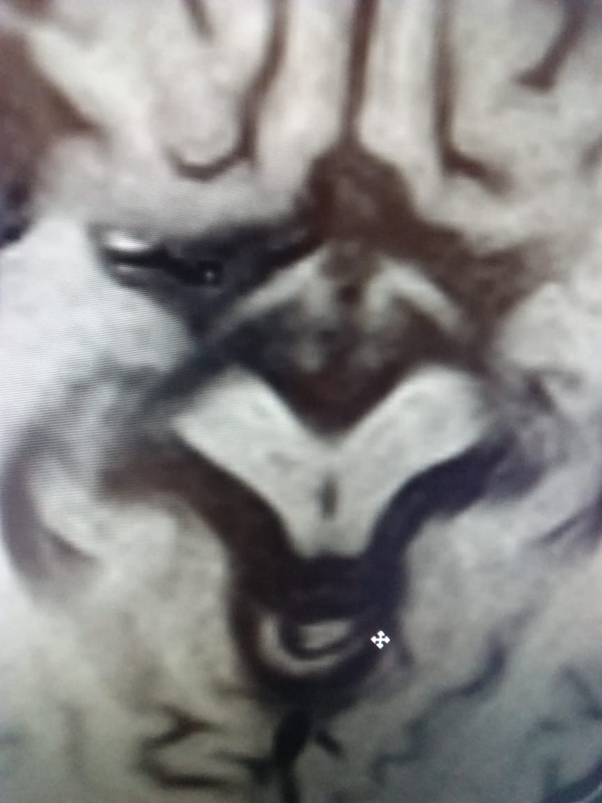 Progressive Supranuclear Palsy Mri Sumers Radiology Blog