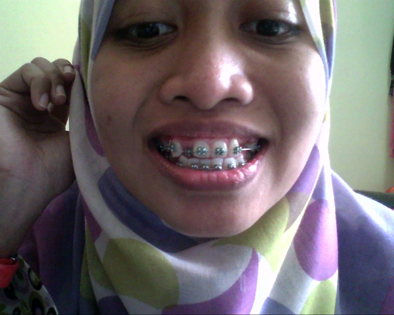 Luggage Oren, Reben Merah: Braces @ Pendakap Gigi @ Gigi Besi ...