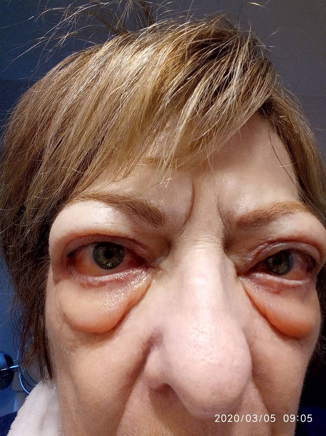 LA MALADIE DE BASEDOW