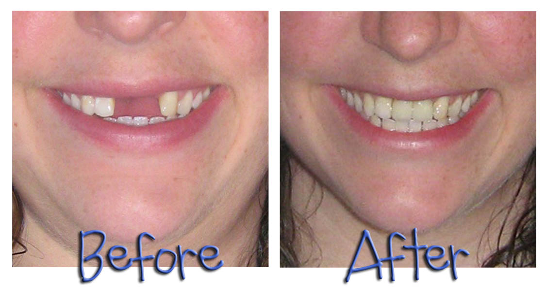 @ the Petersons: Real Teeth!!