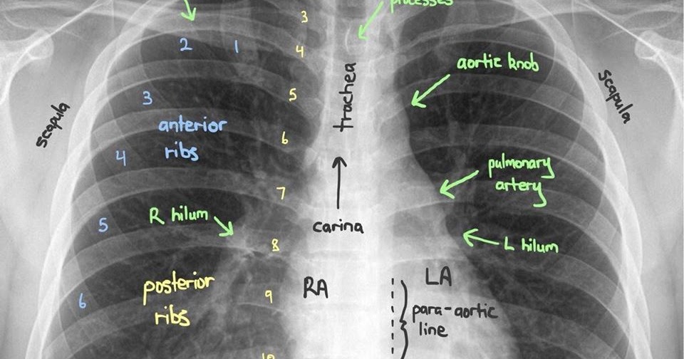 ZONA DE SALUD DE OFRA: Rx tórax. Puntos clave.