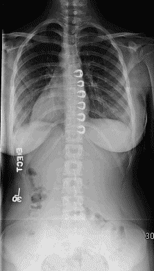 Vertebral Body Stapling (VBS) Part 1 | Growing Spine Blog | Washington ...