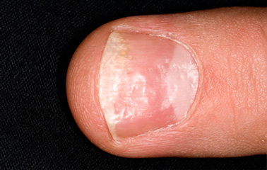 Nail pitting: Nail pitting causes