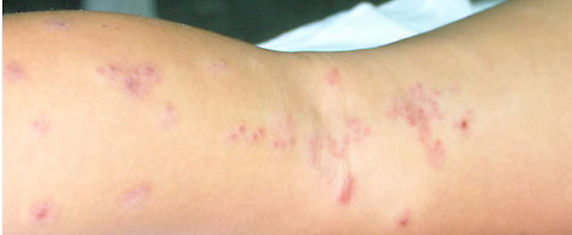 Ringworm Symptoms Causes Treatment And Ringworm Scalp And Body