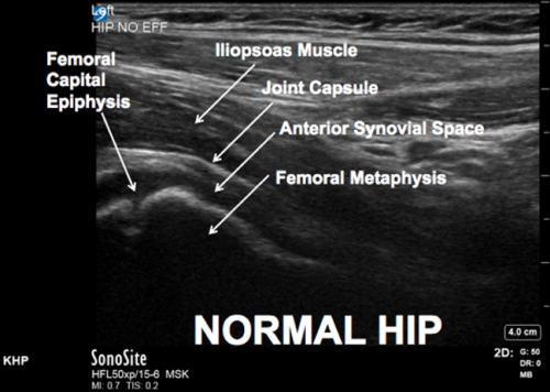 SONOGRAPHIC ANATOMY HIP JOINT AND JOINT EFFUSION
