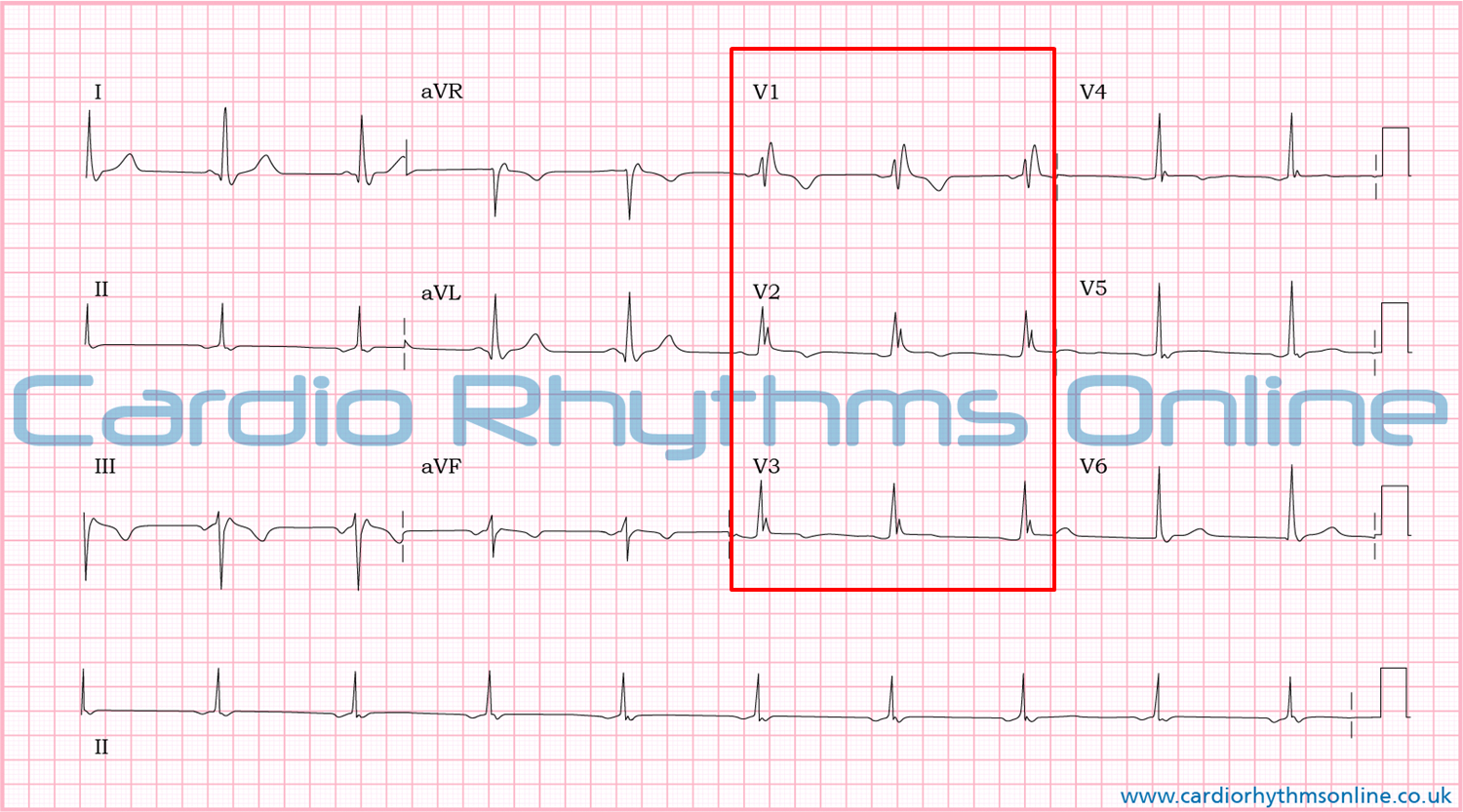 Right Bundle Branch Block