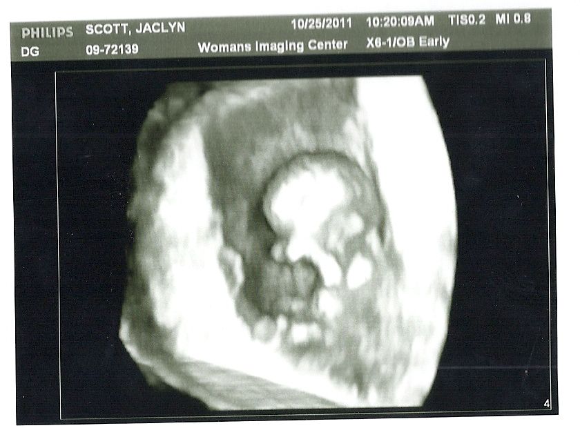 Our Scott Spot: 11 Week Ultrasound