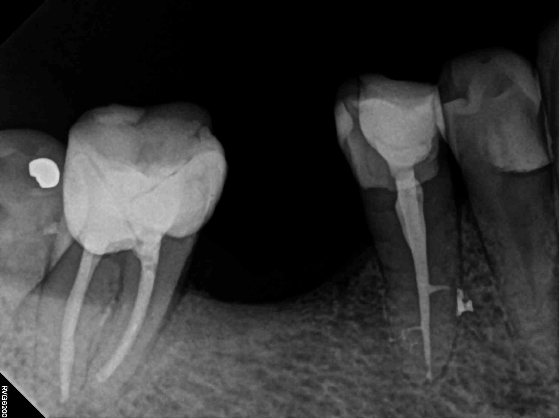 TRATAMIENTO DE CONDUCTOS: Premolares Inferiores