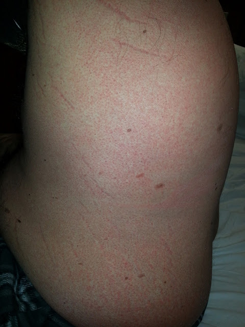 Just Another Bump in the Road - Melanoma : Busiest day EVER!!