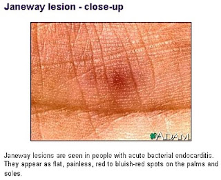 Medicine Mnemonics: INFECTIVE ENDOCARDITIS