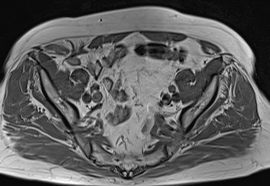RADIODIAGNOSIS - IMAGE COLLECTION: MRI in Spigelian Hernia