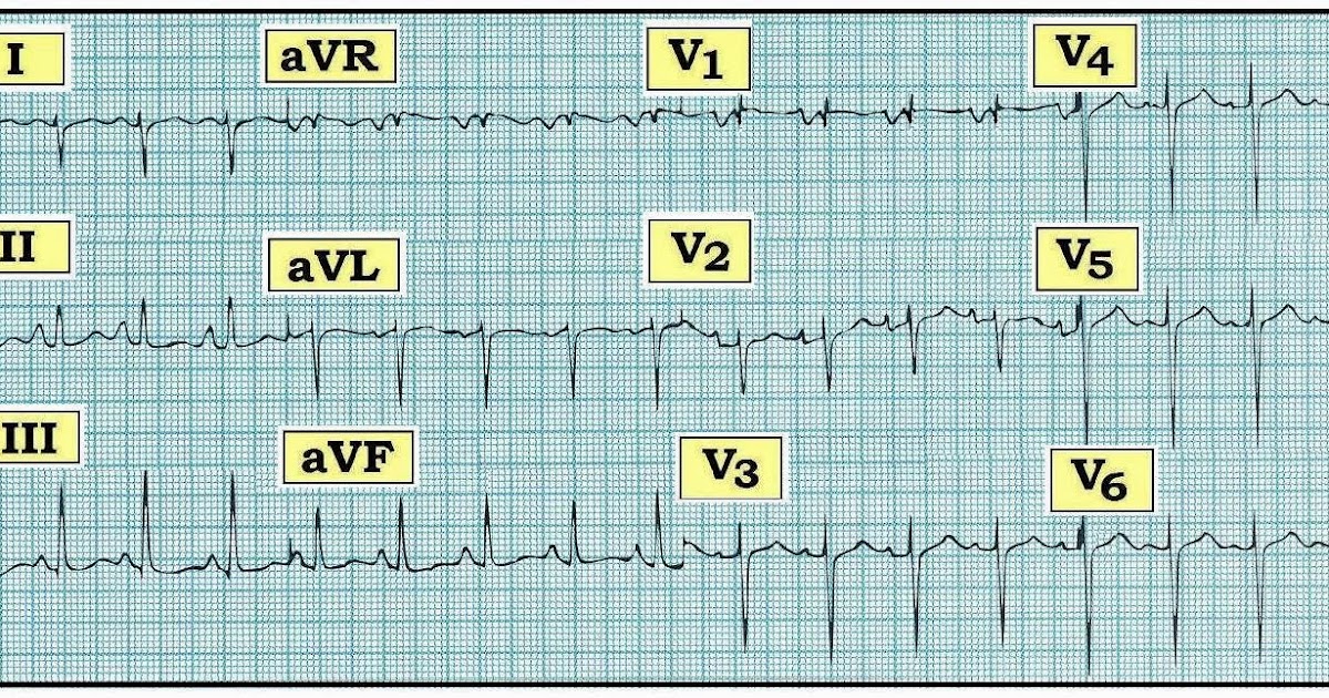 ECG Interpretation: ECG Interpretation Review #77 (Chamber Enlargement ...