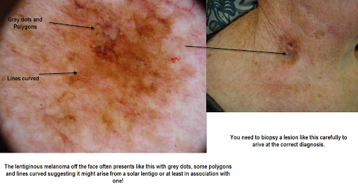 Dermoscopy Features as Clues: Grey dots, clods, circles or lines