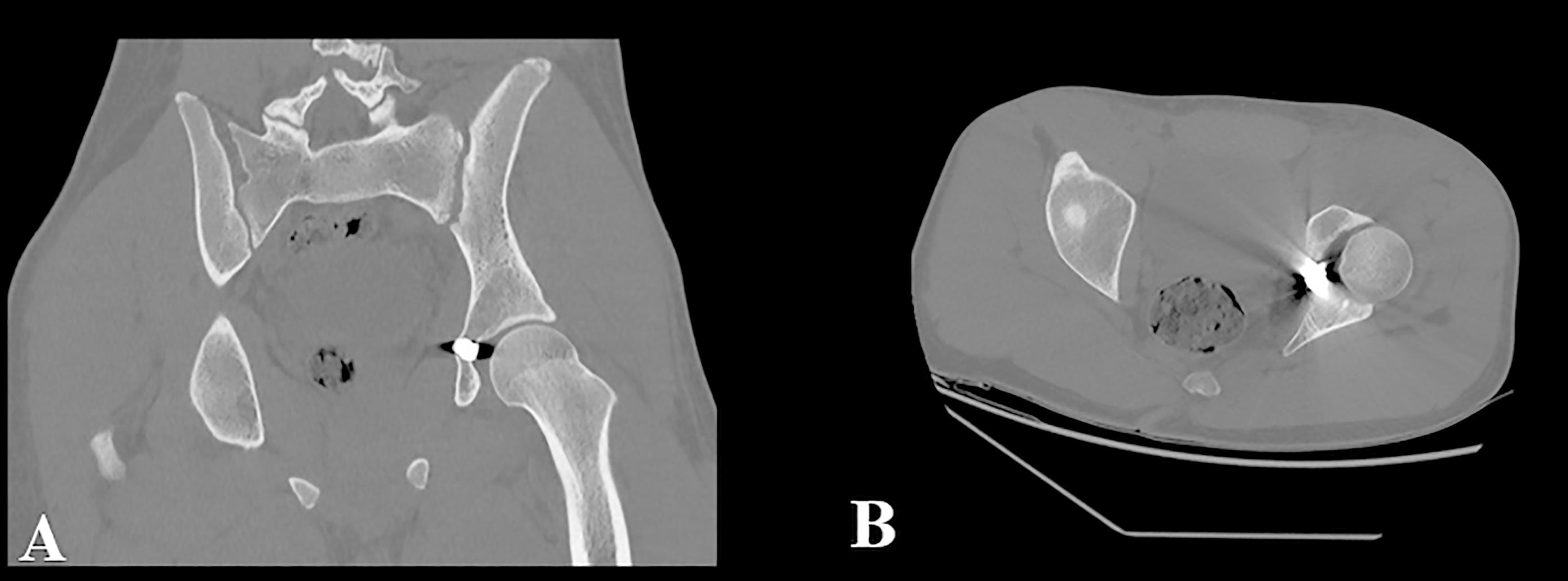 Revisiones_bibliográficas TyO_Web: Abordaje de Stoppa modificado: más ...