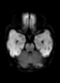 pediatric neurology: The consequence of a reversal sign 2