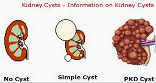 Ask Kidney Doctor: Causes and Symptoms of Kidney Cyst
