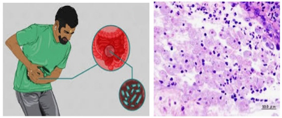 Dysentery: Sign and Symptoms, Causes, Diagnosis, Treatment and Prevention.