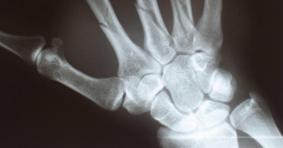 March Fracture Treatment | March Bone Fracture Surgery