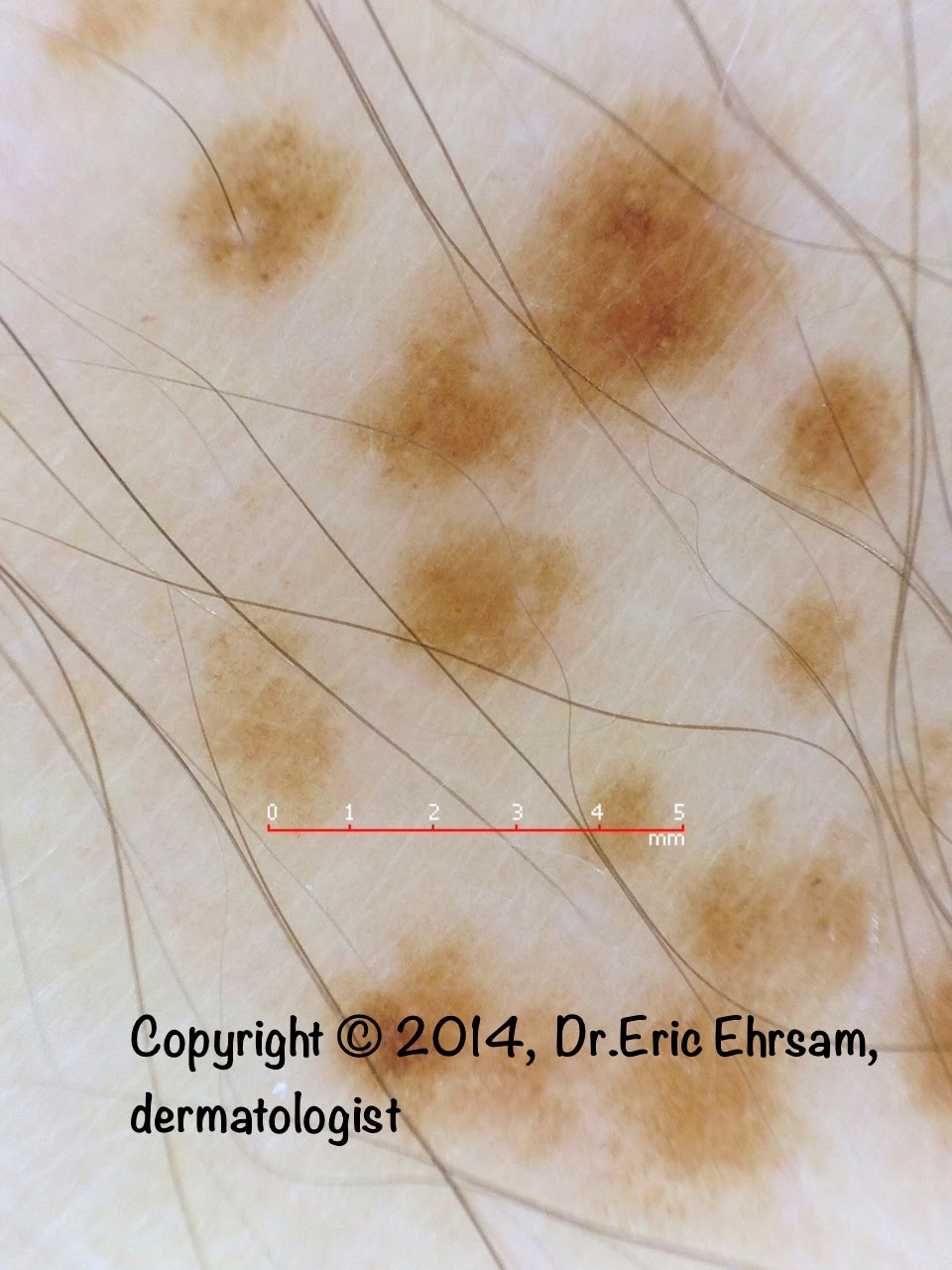 dermoscopy: June 2014