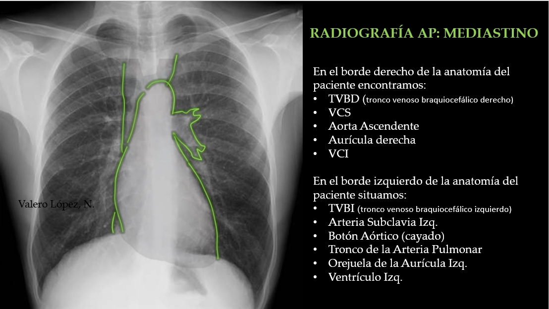 Radiografía de Tórax. Bordes del Mediastino. TC, TAC.